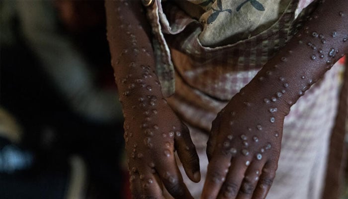 Third of Burundi mpox cases in children under five: UN