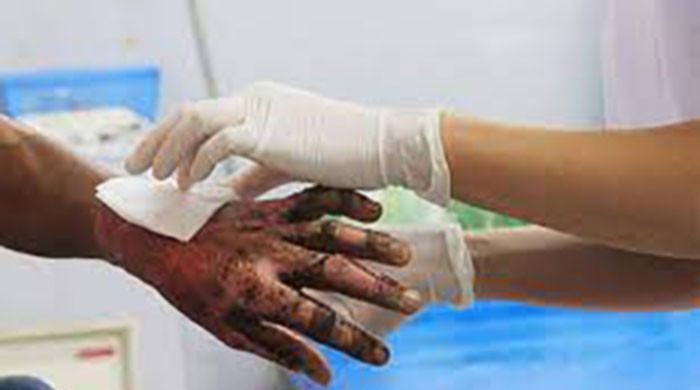 Action urged as burn cases surge among children under 10